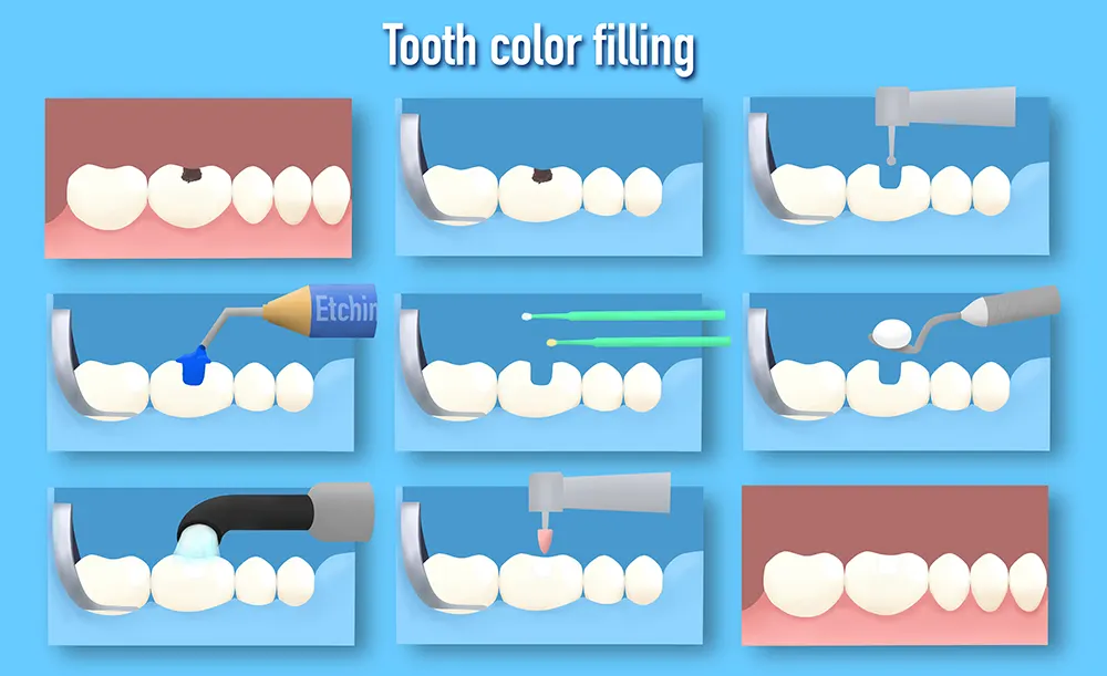 tooth filling procedure code